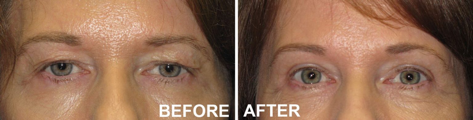 Oculoplastics Clemson | Oculoplastic Surgery SC | Clemson Eye