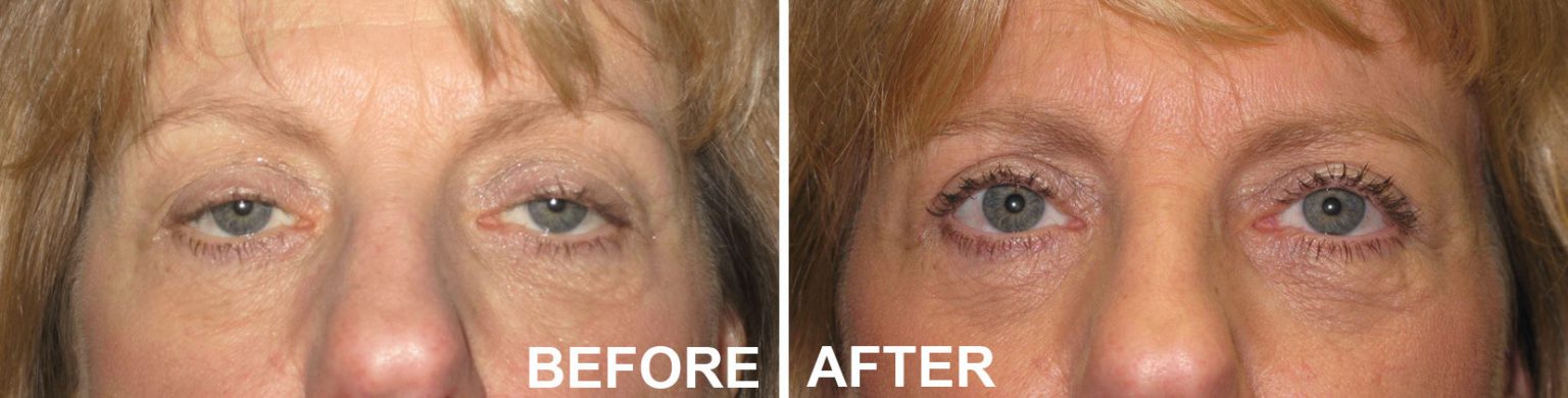 Oculoplastics Clemson | Oculoplastic Surgery SC | Clemson Eye