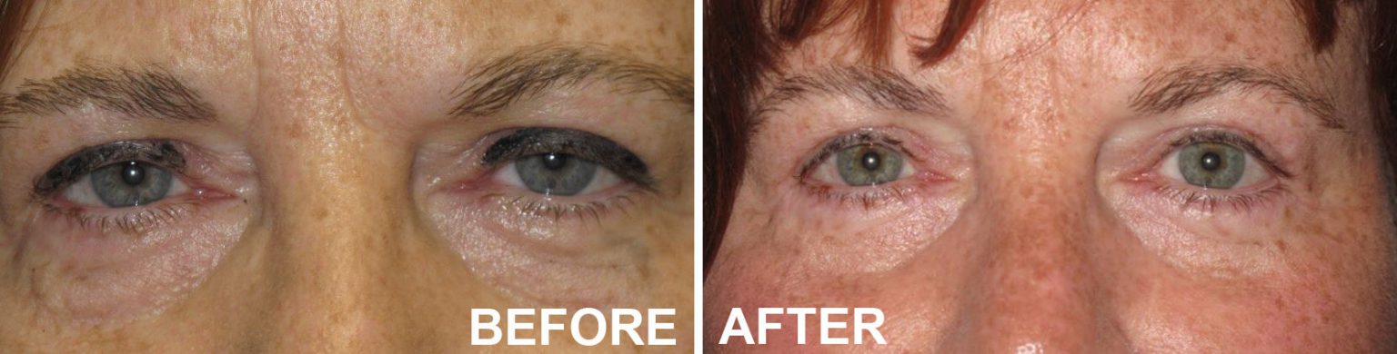 Oculoplastics Clemson | Oculoplastic Surgery SC | Clemson Eye