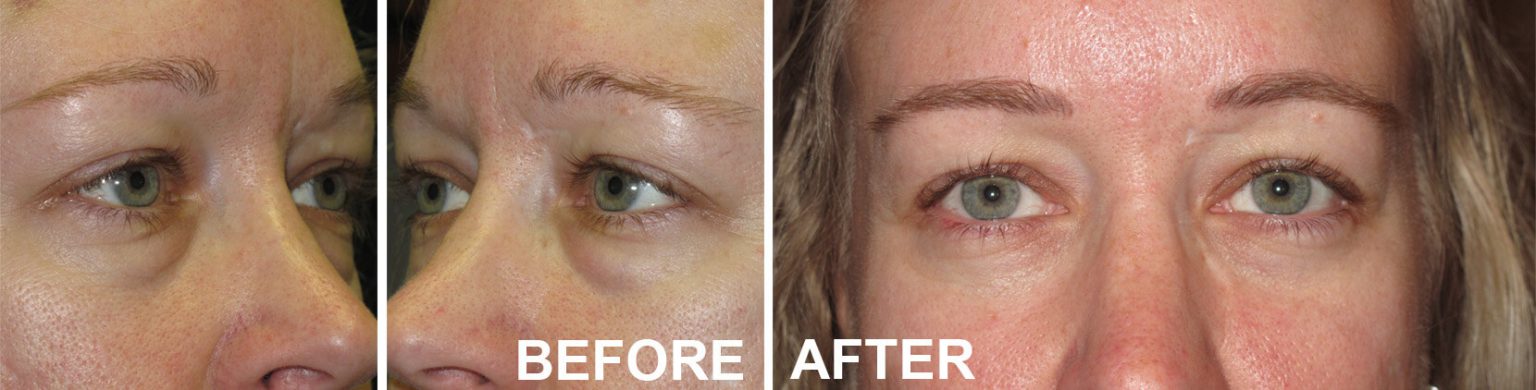 Oculoplastics Clemson | Oculoplastic Surgery SC | Clemson Eye